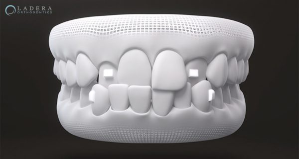 What Are Invisalign Attachments and When Are They Needed?